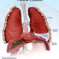 Efusi Pleura | Indonesia Re